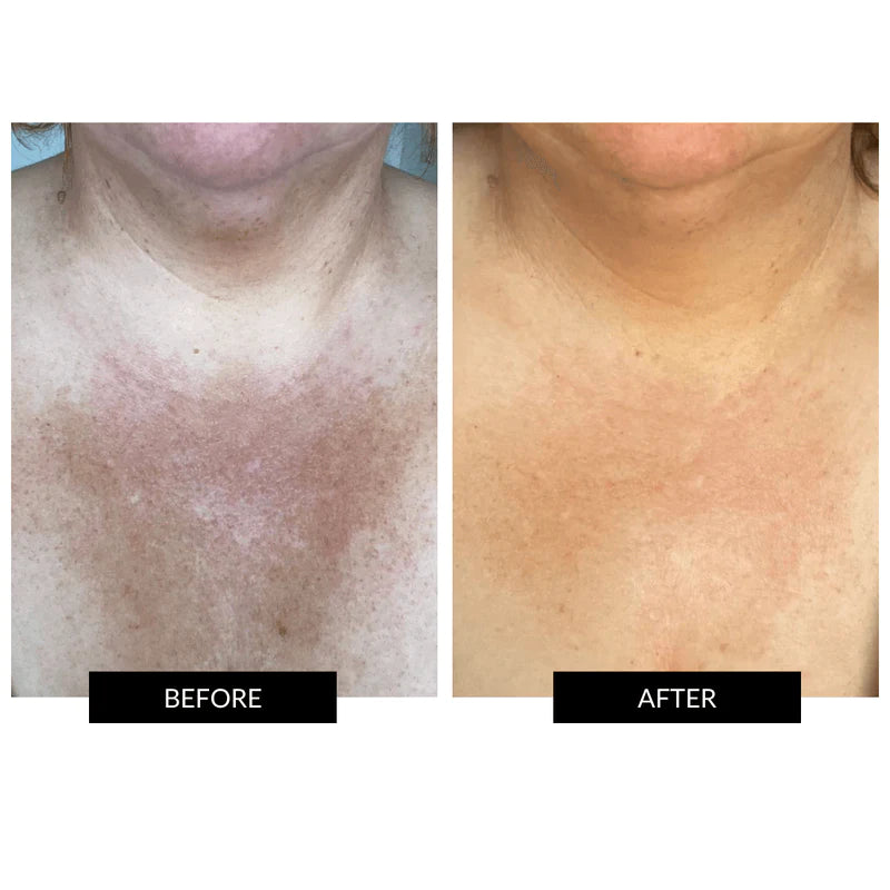 Skin LED Neck and Dec Perfector | The Skin Savant by Amy Peterson